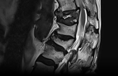 Kyphoplasty: Minimally Invasive Spine Fracture Treatment